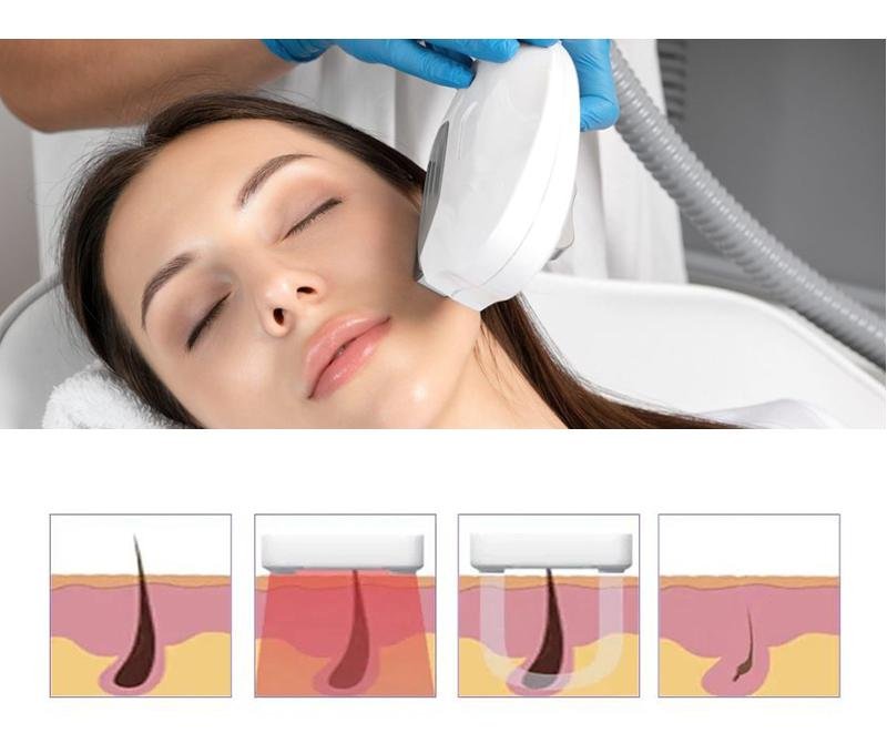 What is Intense Pulsed Light? - lufenlaser.com